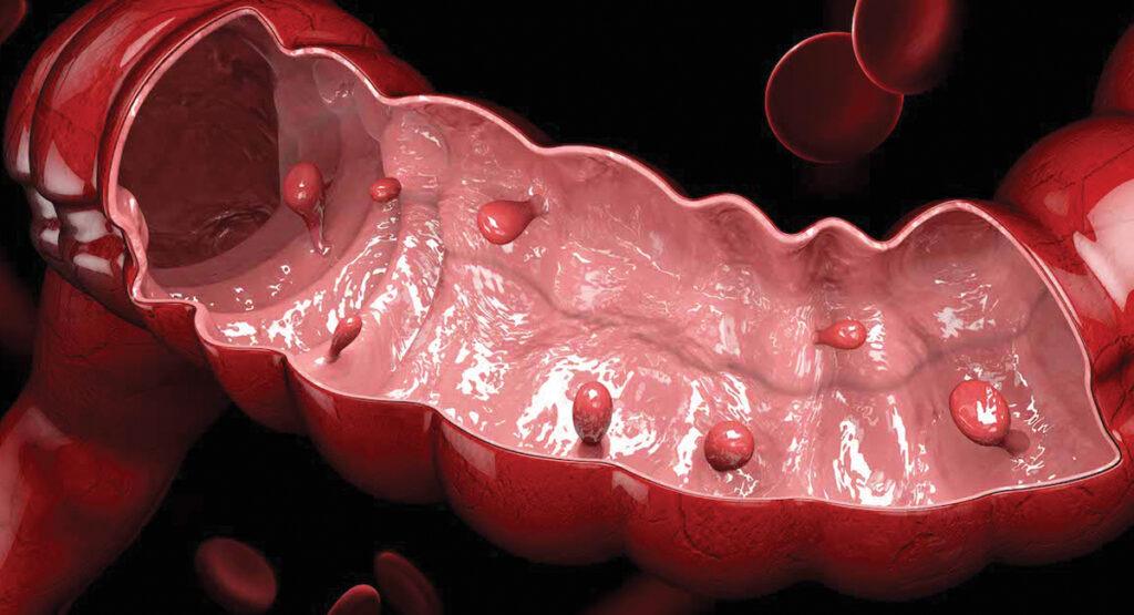 Best Hospital for Colon Polyps Treatment in Bangalore