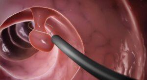 Best Rectal Polyps Treatment In Bangalore By Specialist Doctors