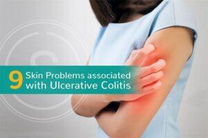 Skin Problems Associated With Ulcerative Colitis | SMILES