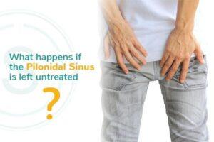 What Happens When Pilonidal Sinus Is Left Untreated | SMILES