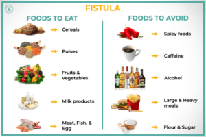 Best Fistula Diet Chart for Faster Healing & Prevention of Recurrence