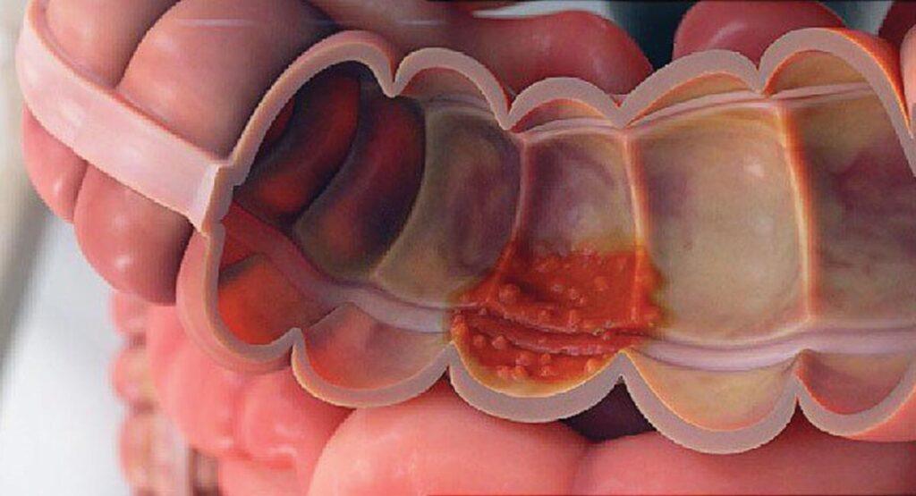 Best Ulcerative Colitis Treatments | Smiles Gastroenterology